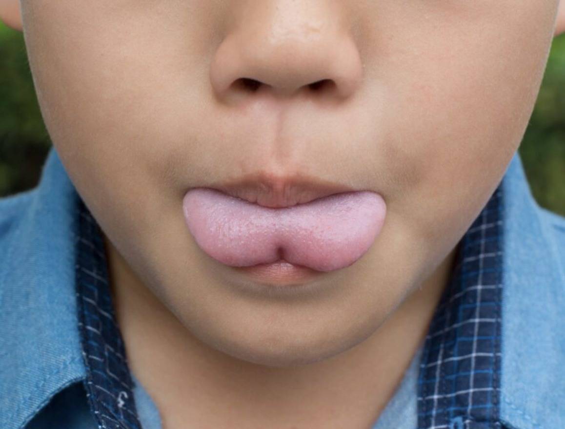 Frenectomy - .: Sunshine Dental